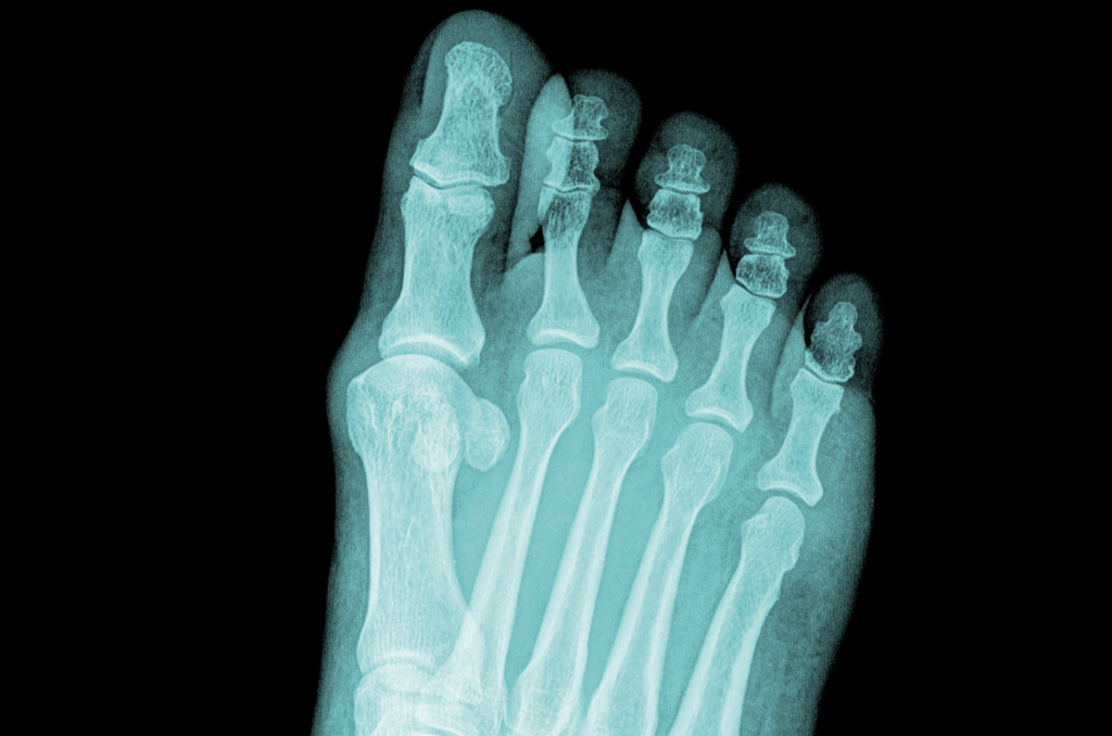 Gout - This Quarterly